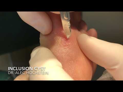 Inclusion Cyst