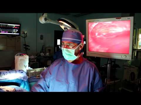 VAT Lung Biopsy Procedure - Alexander R. Marmureanu MD