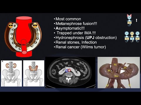 Horseshoe kidney: Explained, High Yield points Schematic Med