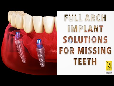 A Permanent Solution to Replacing Bad Teeth