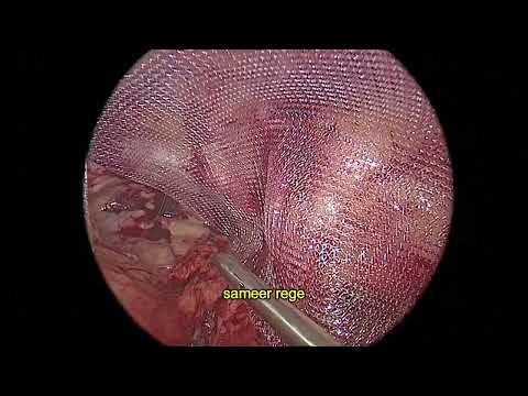 Laparoscopic TAPP for Pfannenstiel incisional hernia
