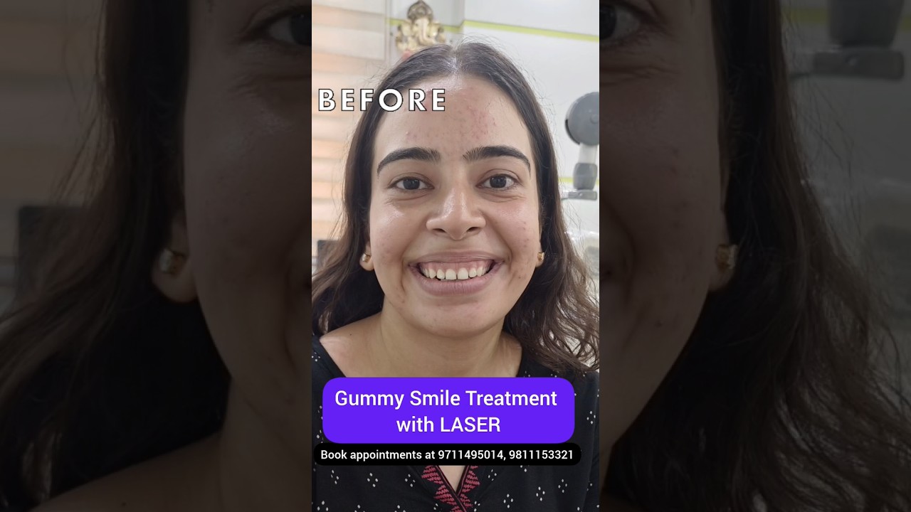 Gummy Smile Treatment with LASER; Dr. Srishti Bhatia #laser #teeth #smilemakeover