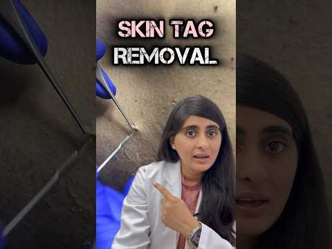 Skin tag removal | Skin tags on neck | How to remove skin tag
