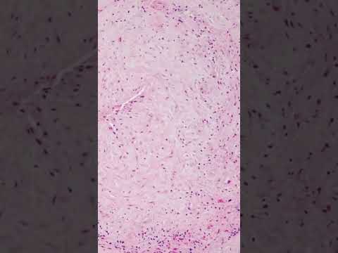 Giant cell (temporal) arteritis- Pathology #shorts