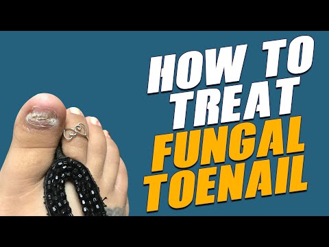 Watch Dr. K's SHOCKING Toe Nail Fungus Removal! 😱