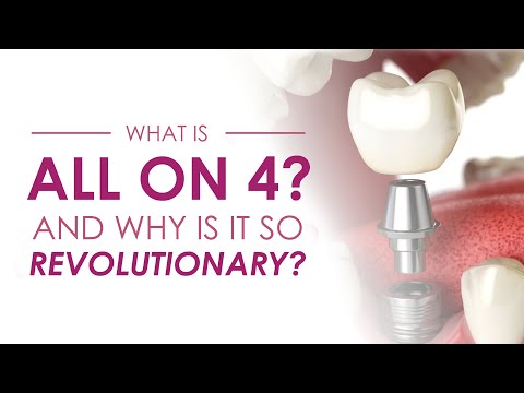What is All on Implants and Why is It So Revolutionary?