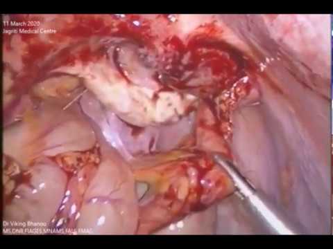 Adherent Appendix, to the fallopian tube. Appendix on the ceiling.