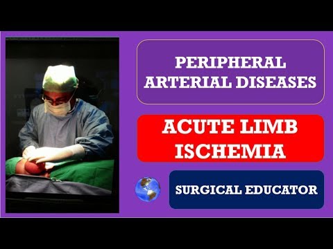 ACUTE LOWER LIMB ISCHEMIA-- How To DIAGNOSE & TREAT/ Peripheral Arterial Diseases
