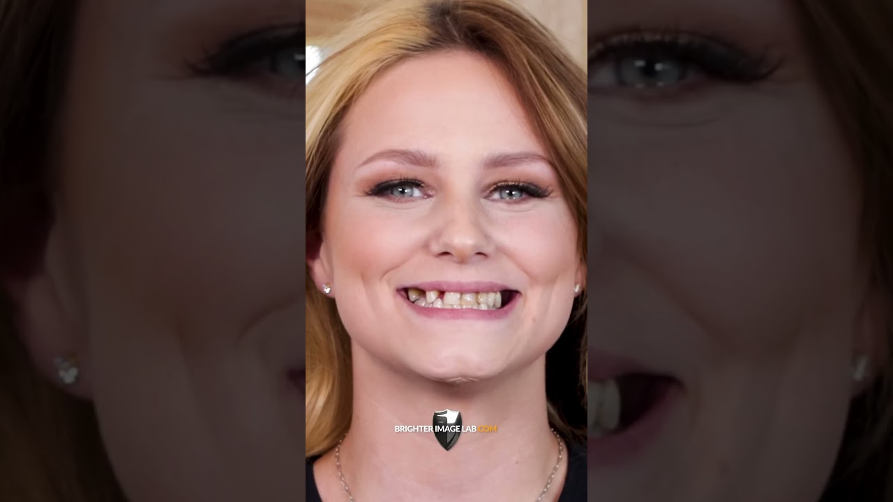 Missing Teeth? Incredibil™ Snap On Veneer - No Dentist Clip On Will Shock You!