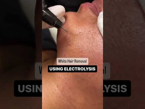 Electrolysis Hair Removal