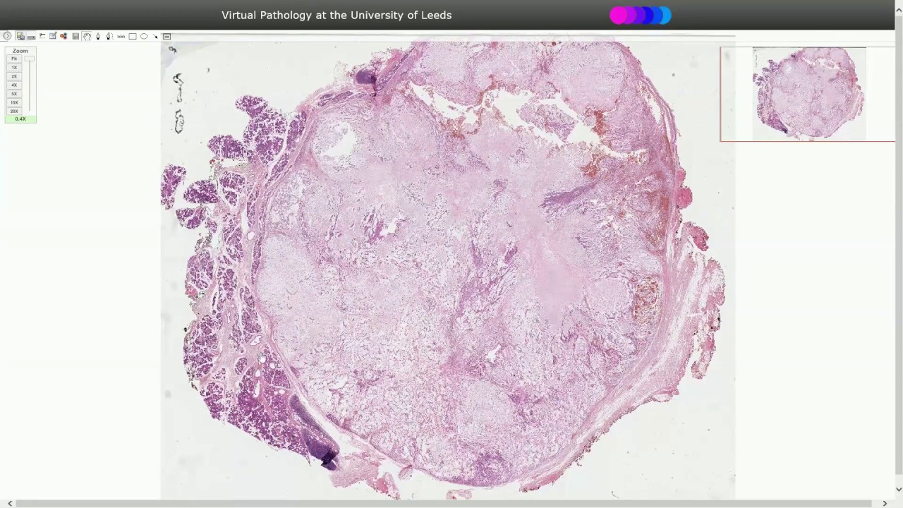 Pleomorphic Adenoma - Histopathology