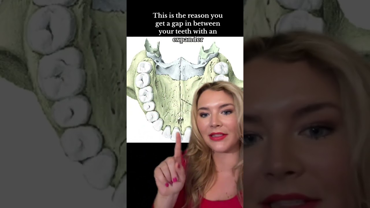 How expanders work! #braces #invisalign #expander
