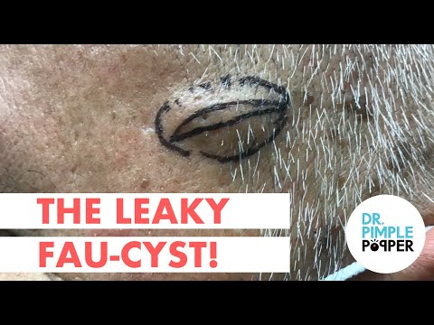 Dr. Pimple Popper Pops 'Leaky Faucet' Cyst In New Youtube Video
