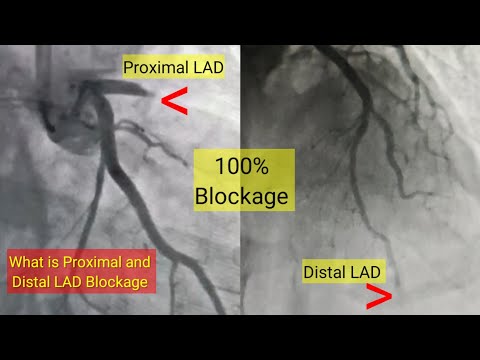 What is proximal and Distal LAD artery Blockage and Treatment l हार्ट ब्लॉकेज और ईलाज