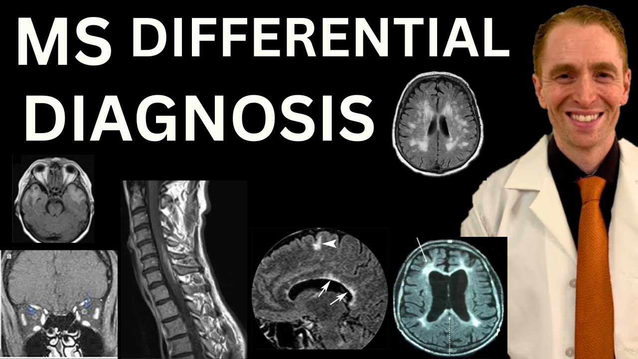 Multiple Sclerosis Differential Diagnosis