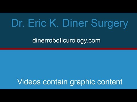 Robotic Bilateral Ureteral Reimplantation - Dr. Eric Diner