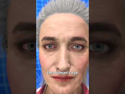 23 Contacts Stuck In Her Eye ๐จ