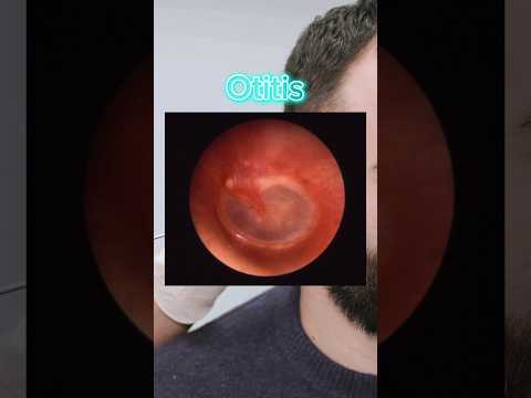 Expand Your Vocabulary Mastery: OTITIS - MEDICAL DEFINITION