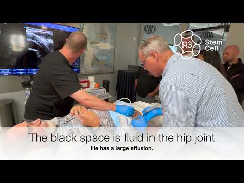 Ultrasound Guided Hip Injection with R3 Stem Cell (844) GET-STEM