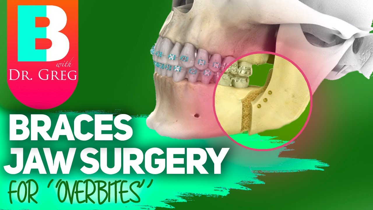 Braces Jaw Surgery for Overbite Correction (Overjet Correction)