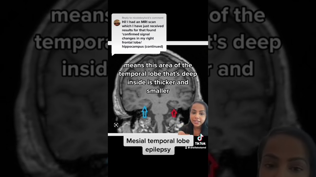 Mesial temporal epilepsy