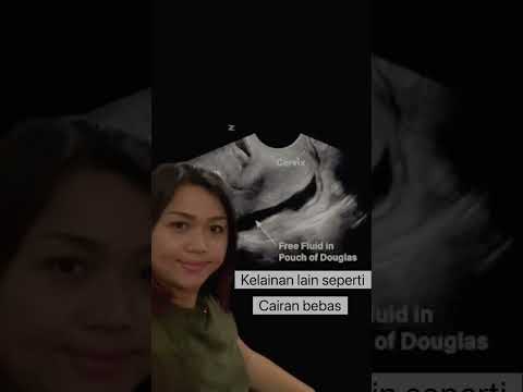 Apa Yang Bisa Kita Lihat Saat USG Transvaginal ?