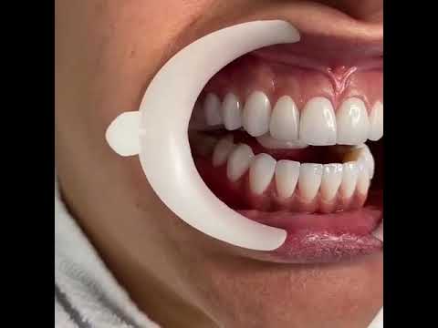 All-On-4 metal ceramic (Straumann implants)