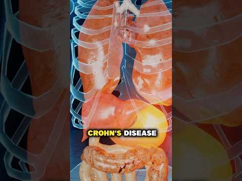 Healing From Crohn’s disease #crohnsdisease #fermentedfood #expectmiraclespodcast
