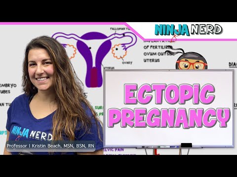 Ectopic Pregnancy