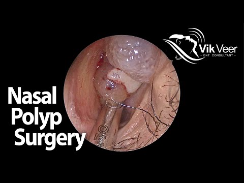 Watch me remove Polyps from the nose!