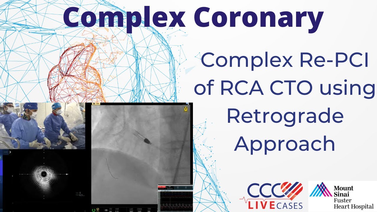 Complex Re-PCI of RCA CTO using Retrograde Approach