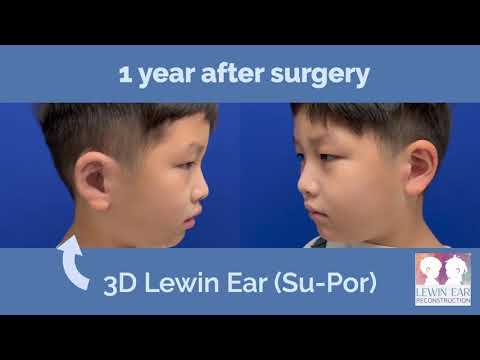 Microtia Ear Surgery - Evaluate results critically