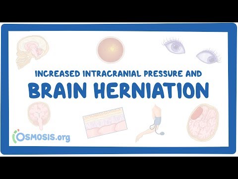 Brain herniation – causes, symptoms, diagnosis, treatment, pathology ...