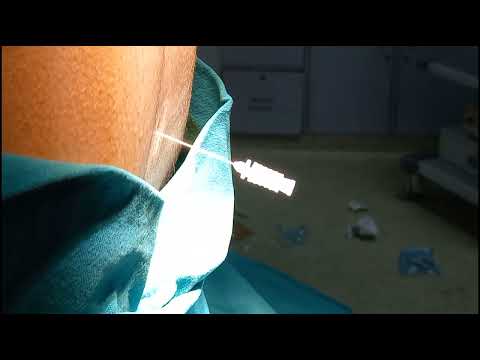Best technique of spinal anaesthesia