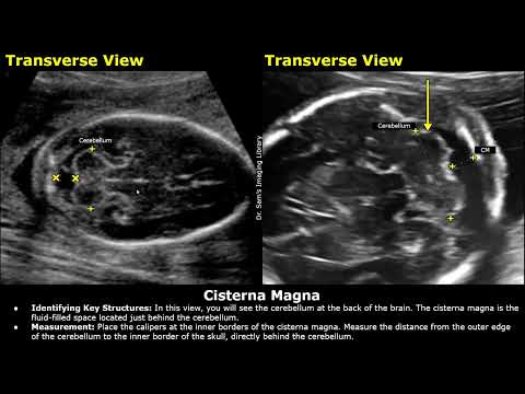 How To Measure Fetal Cisterna Magna On Ultrasound | Fetal Brain Anomaly Scan | Obstetric USG