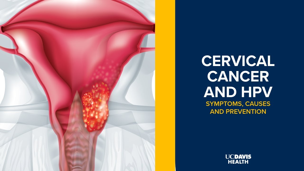 Cervical Cancer and HPV - Symptoms, Causes and Prevention Explained | UC Davis Health