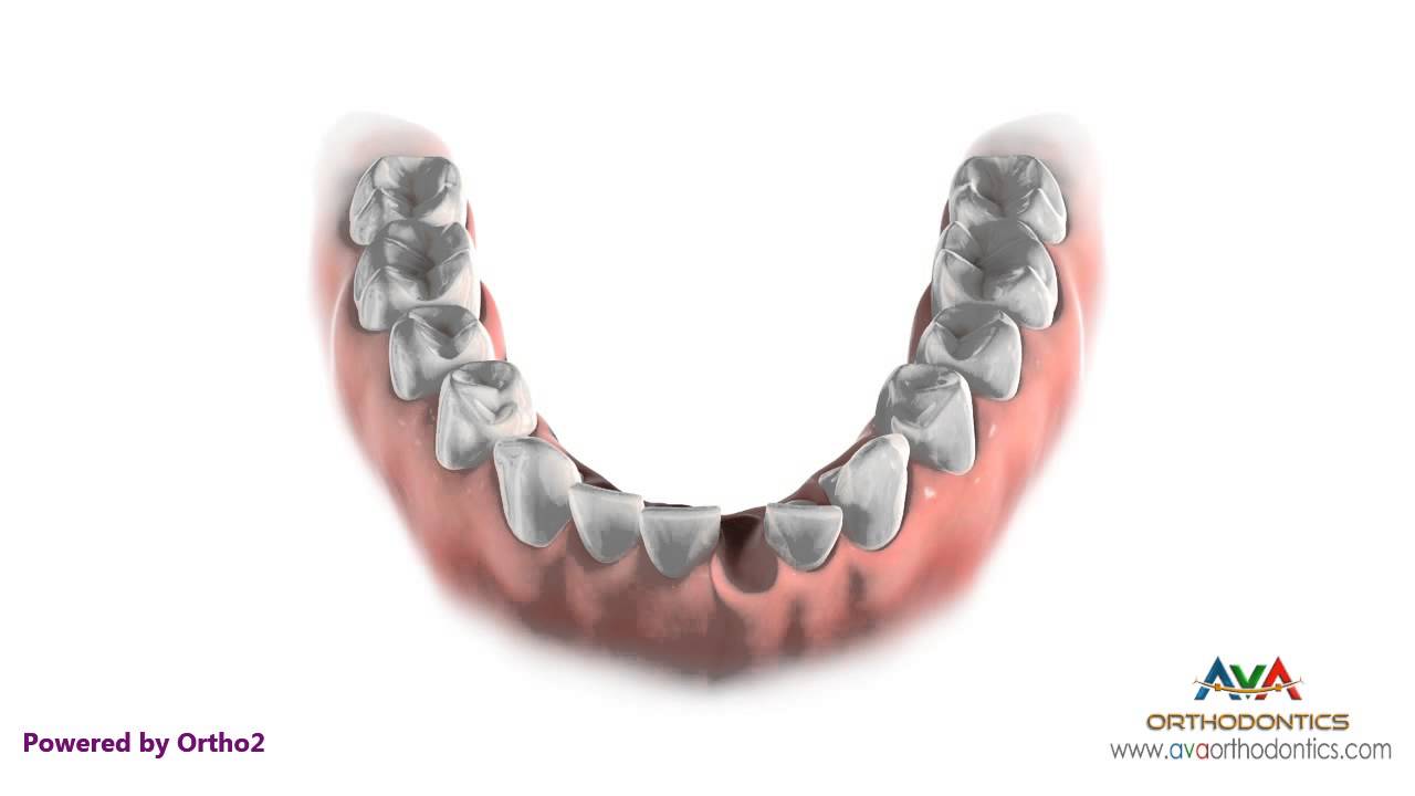 Orthodontic Treatment for Severe Crowding - Removing 1 Lower Front Tooth