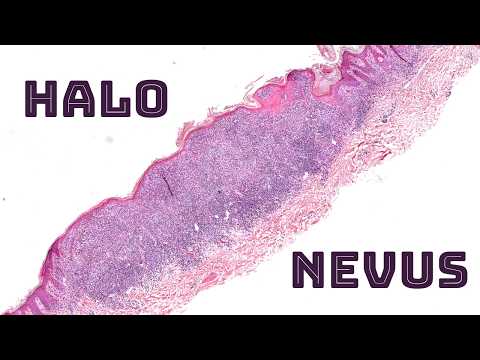 Halo nevus (nevus with brisk inflammation -brown skin spot with white pale halo around it) pathology
