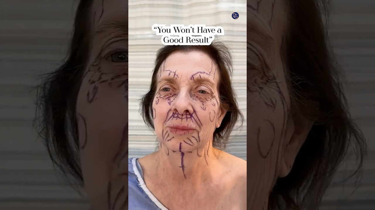 Natural Results| Facelift 2 Months Post-Op| Before and After