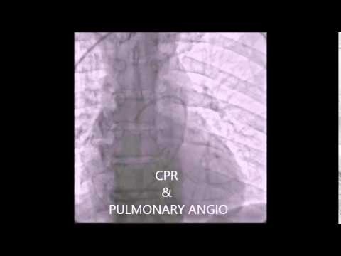 MASSIVE PULMONARY EMBOLISM