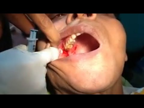 Tooth pain and mobility.