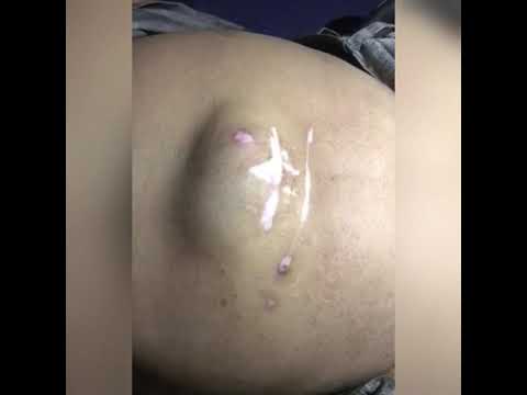 INCISIONAL HERNIA