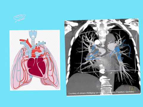 CTA of the Chest for Pulmonary Emboli