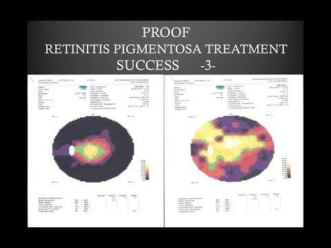 Proof (Visual Field Test Results)