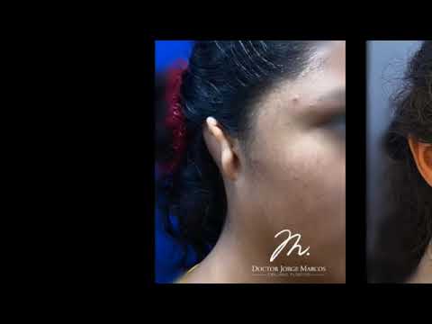 Reconstrucción Auricular con prótesis Osteointegrado