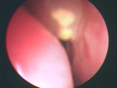 Severe Nasal Mucosal Edema