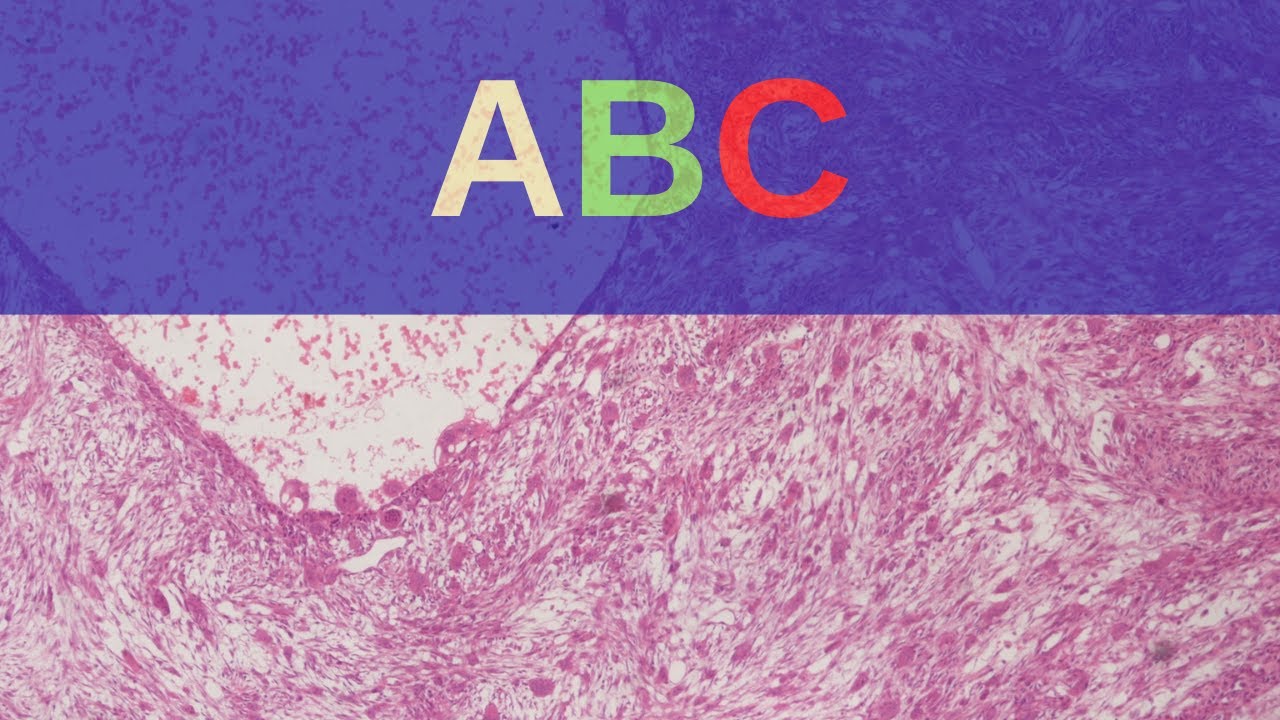 Aneurysmal Bone Cyst - Pathology mini tutorial