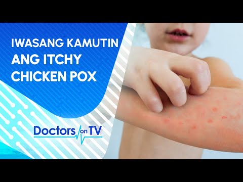 Makating 'Bulutong' o Chicken Pox, ano ang mabisang remedies para sa mabilis na paggaling nito?