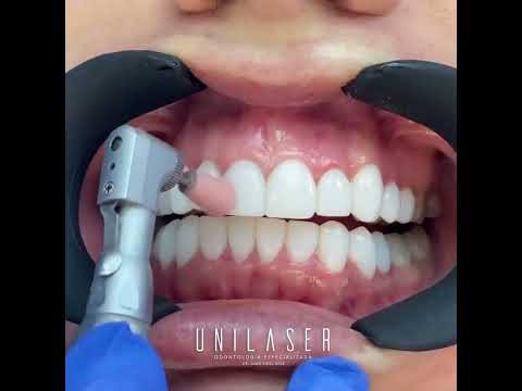 Creating shiny smiles - Bonding veneers (composite veneers)