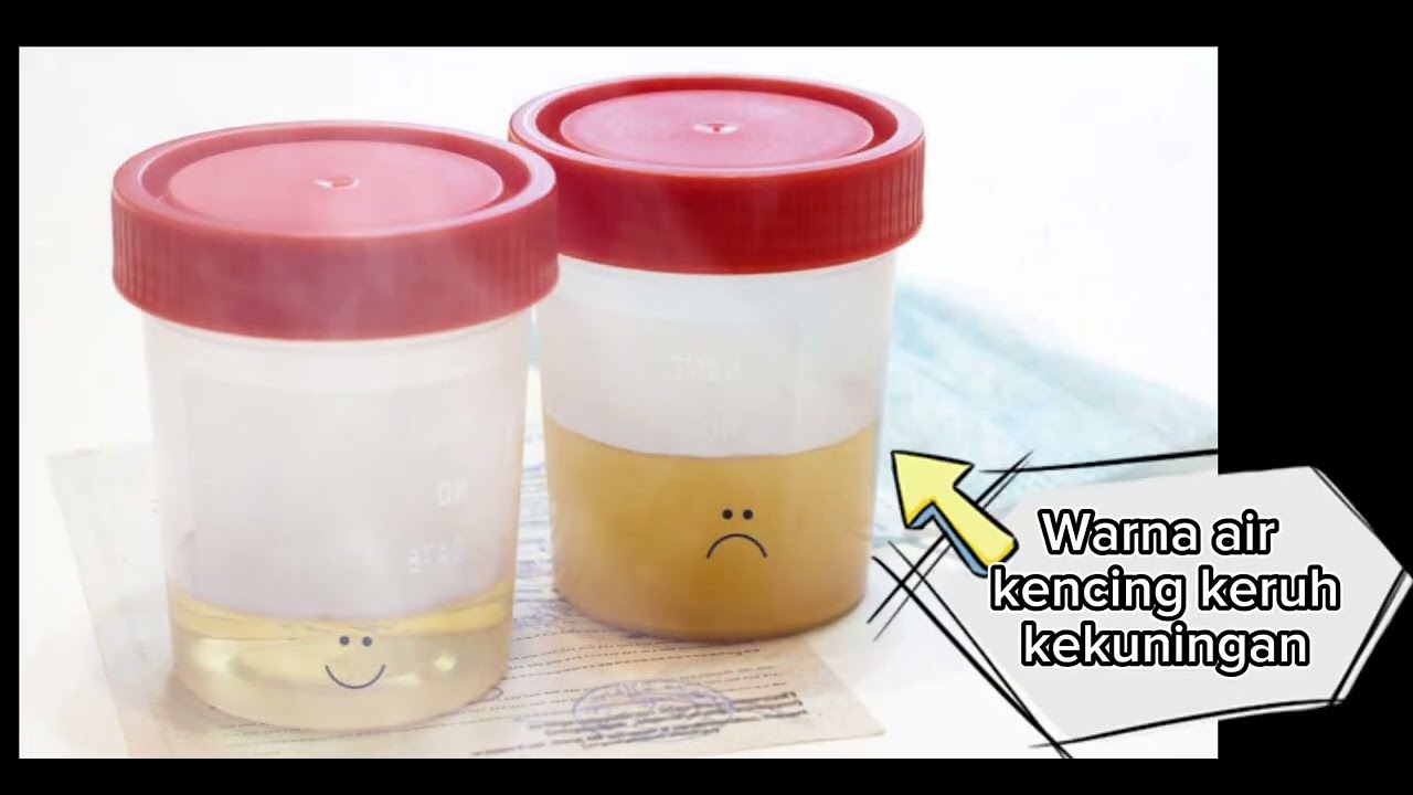 Tanda-tanda kencing kotor #klinikalammedickualasawah #kencing #kotor